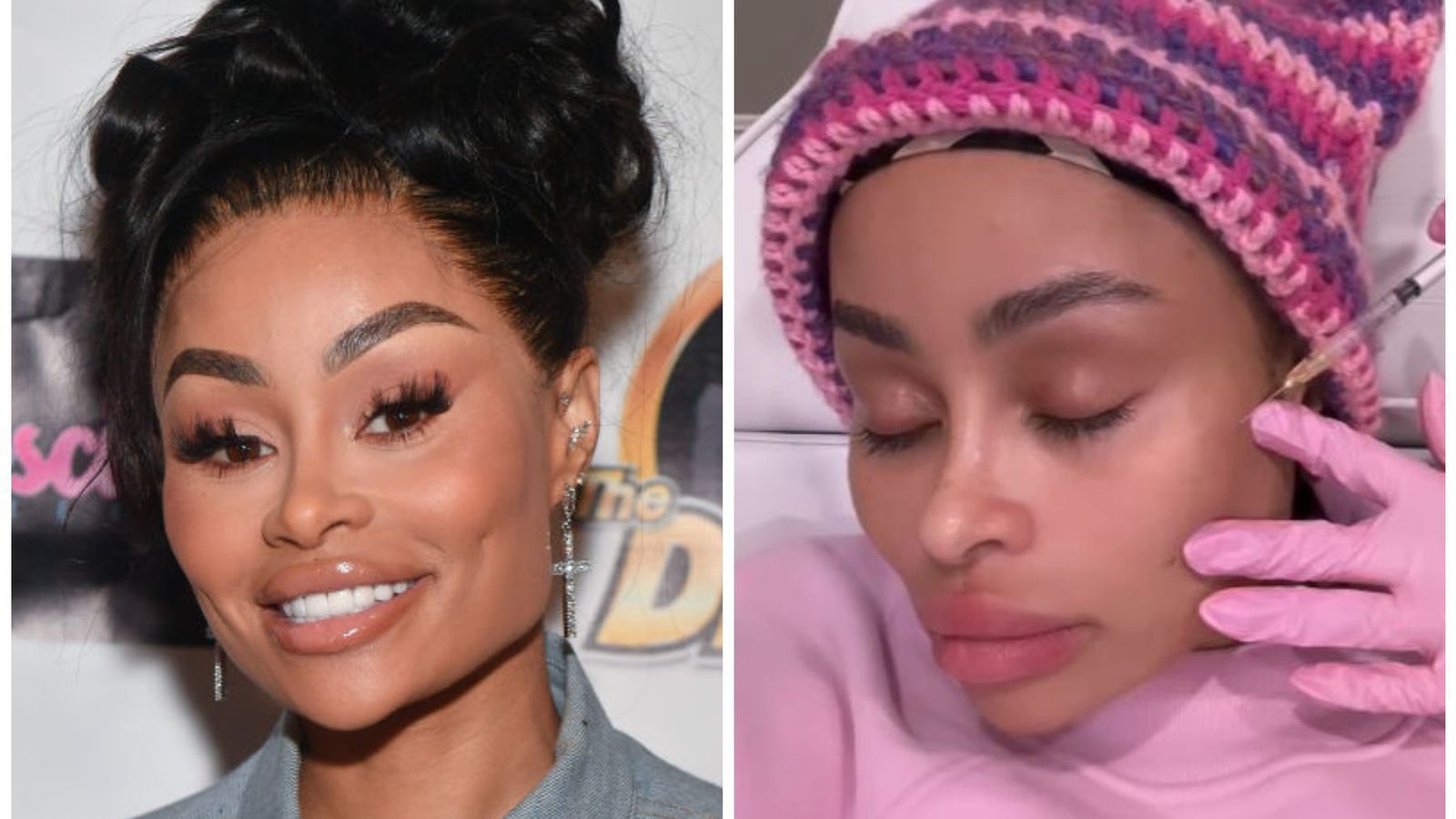 Lét fjar­lægja fylli­efnin og varar ungt fólk við - Vísir